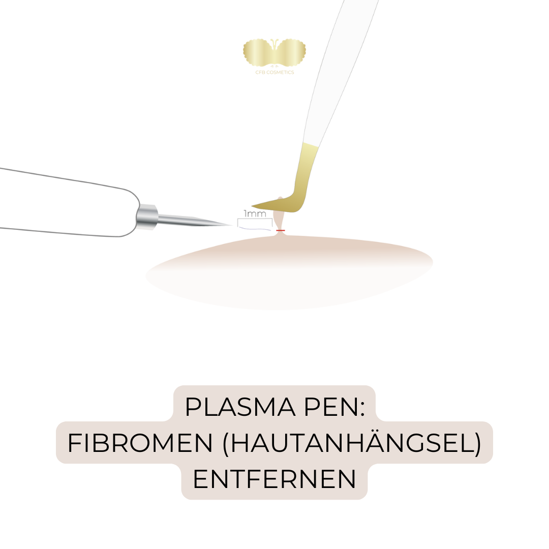 Fibromen entfernen mit dem Plascom® Plasma Pen: Eine schonende Lösung